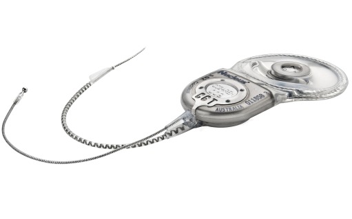 Cochlear announces launch of new cochlear implant - Australian ...