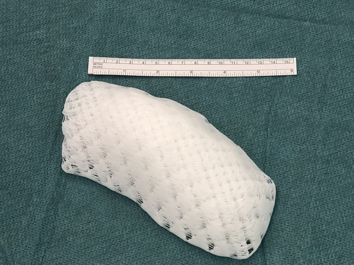 Brisbane team creates world-first 3D printed chest implant - Australian ...