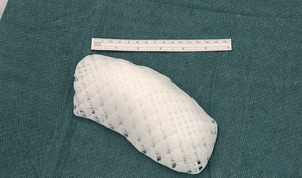 Brisbane team creates world-first 3D printed chest implant - Australian ...