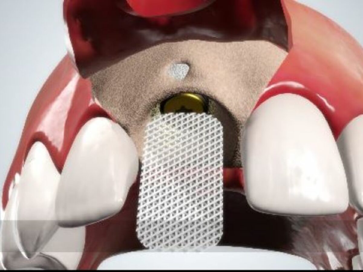 Osteopore reaches dental implant development milestones - Australian ...